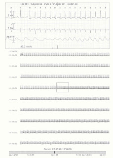 Pedi cardiology: SVT - Onset, Termination - Rentry Mechanism