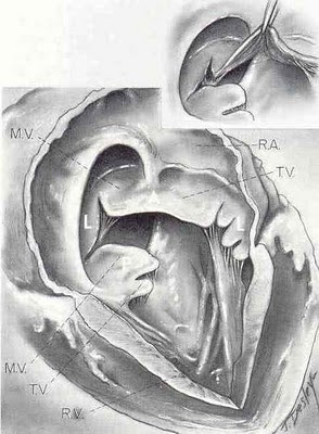 Pedi cardiology: Anatomy: AVSD - Rastelli Types