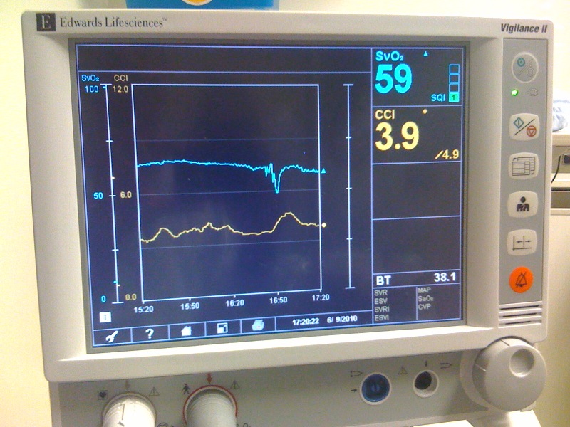 Pedi cardiology: ICU: Swan Ganz Catheter Data