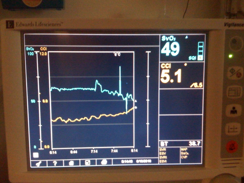 Pedi cardiology: ICU: Swan data display