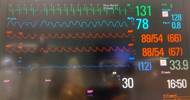 Pedi cardiology: ICU: Monitor - s/p Norwood - Temporary pacemaker ...