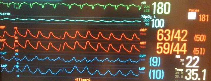 Pedi cardiology: Junctional Ectopic Tachycardia