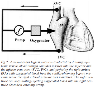 Journal Club: Cannulation in PA-IVS with RV dependent Coronary Circulation
