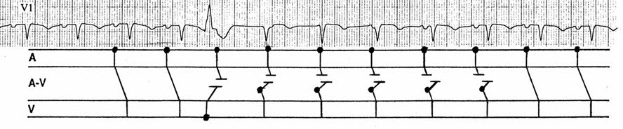 Pedi cardiology: EKG: Interpret this, Learn Ladder Diagram