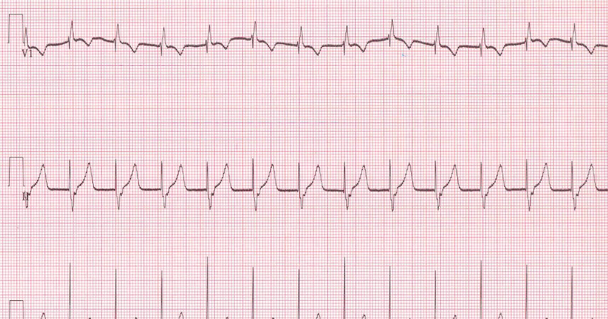 Pe ecg findings - lopezcube