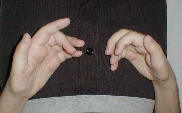 Karyn's View: Hand atrophy/muscle paralysis in ALS