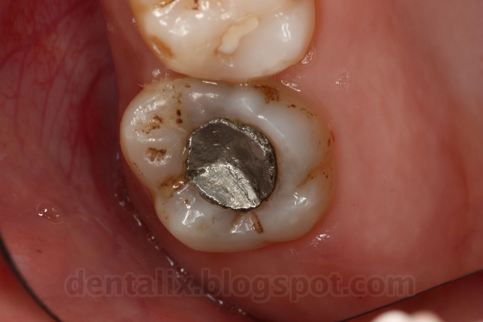 Odontología: Nuevo composite por amalgama