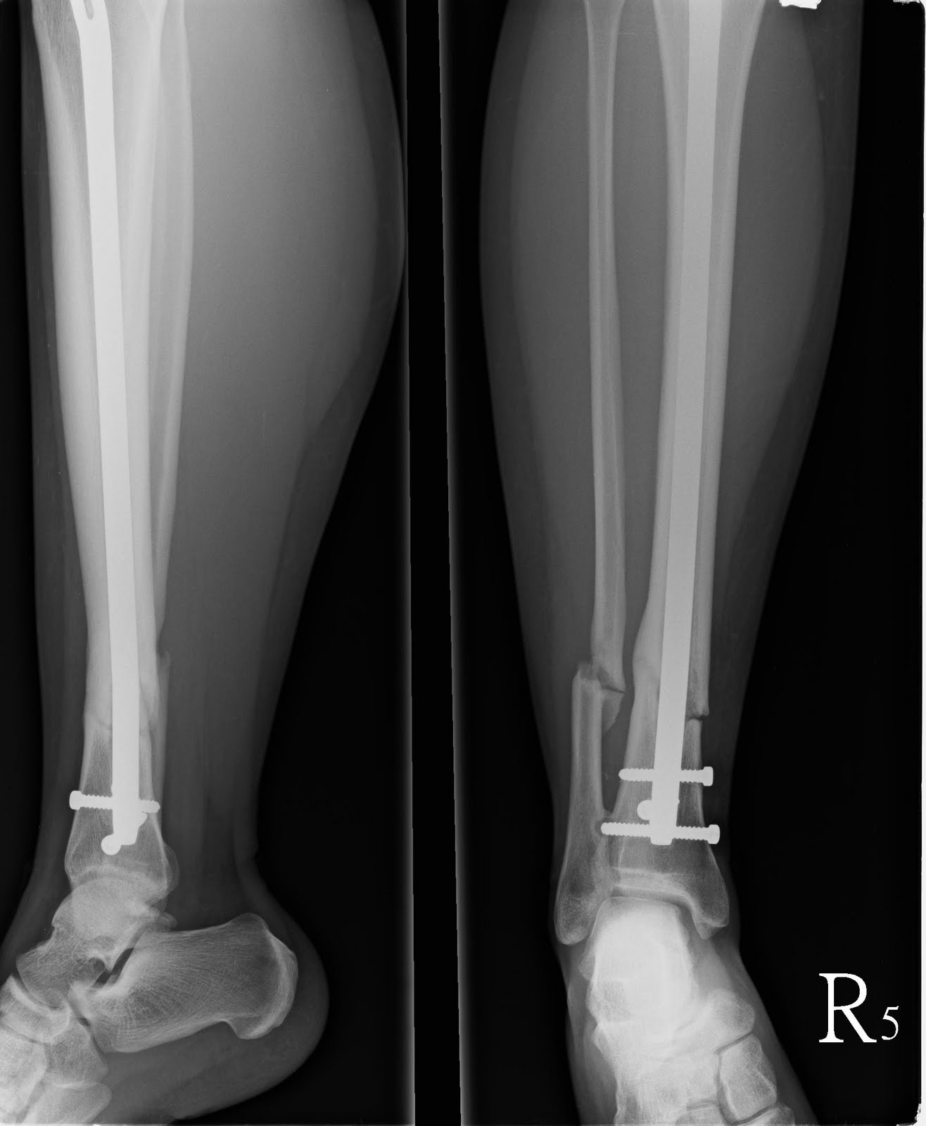 Big Bad: 22 y/o male patient: tibia fracture with partial nonunion