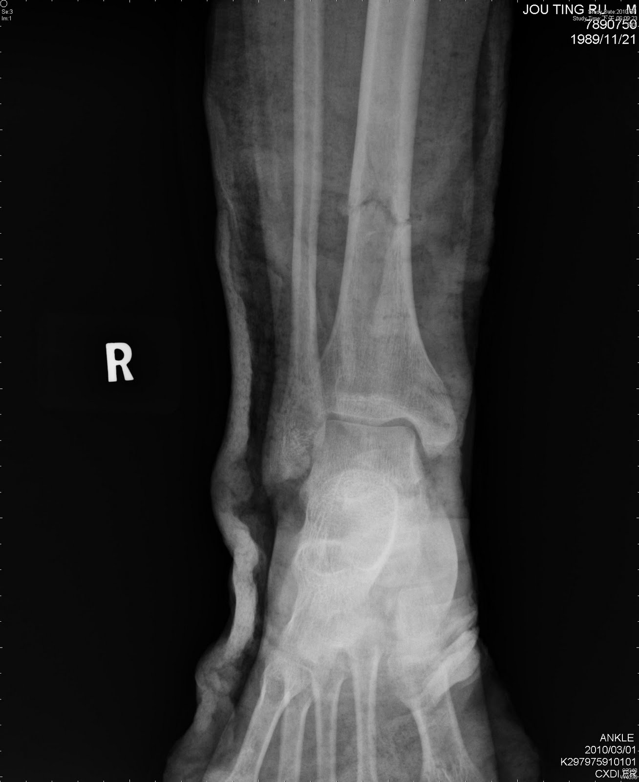 Big Bad: Neighbor tibia low shaft fracture with good callus formation