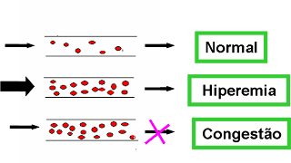 Aprendendo Patologia: Hiperemia / Congestão