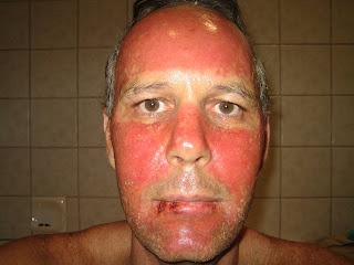 myefudixphotos: day 21 (day 7) efudix