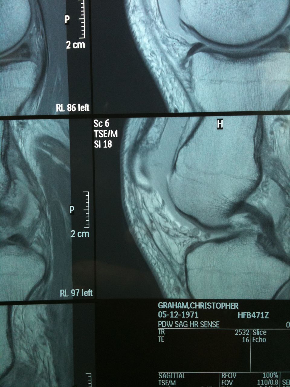 the goodLife: Bionic Knee Surgery on Friday 13th.