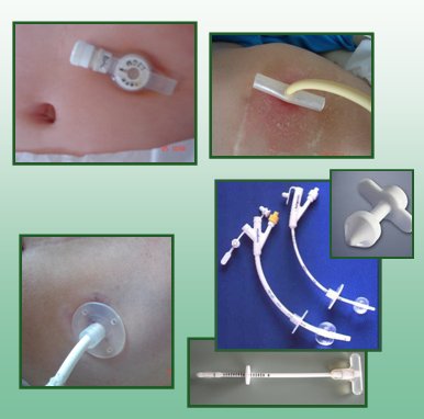 Gastrostomia Sonda