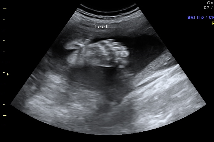 The Fish Family: Baby Ultrasound & Prego pics