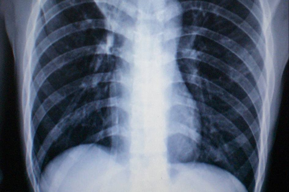 Phimaimedicine: 391. Right upper lobe collapse