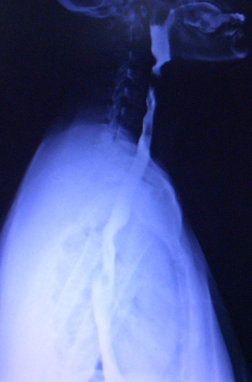 Phimaimedicine: 485. Esophagogram (barium swallow)