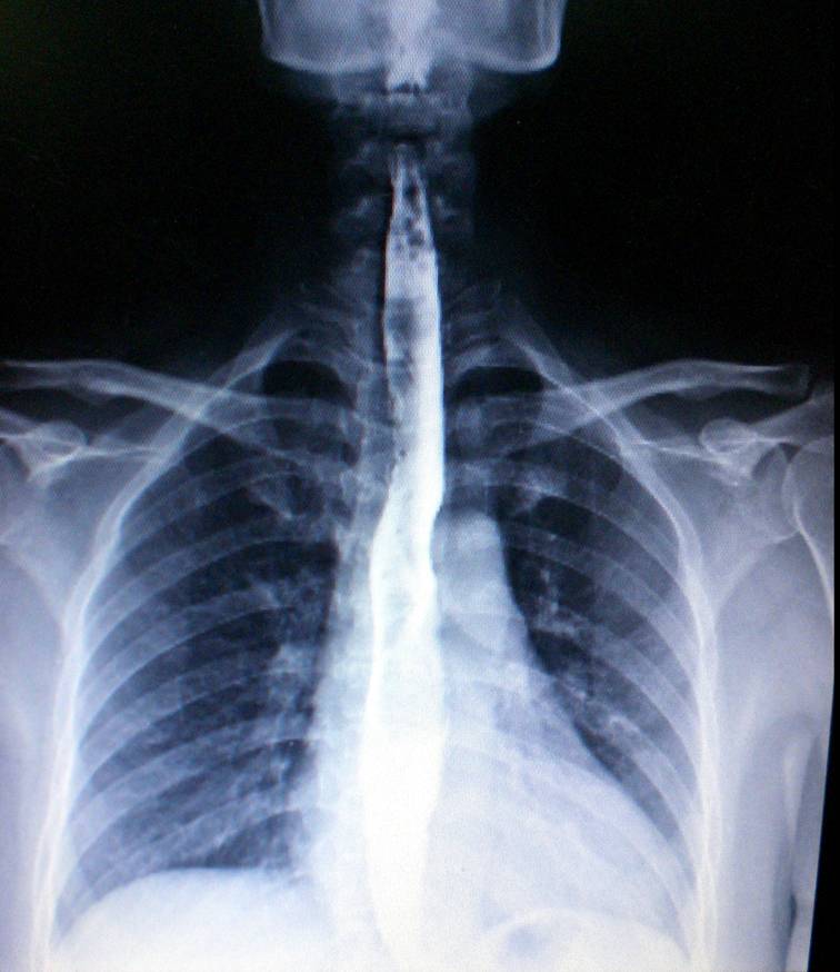 Phimaimedicine: 485. Esophagogram (barium swallow)