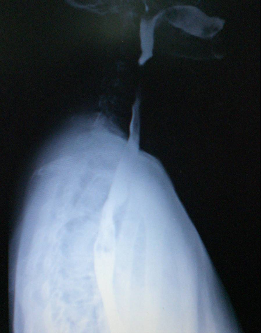 Phimaimedicine: 485. Esophagogram (barium swallow)