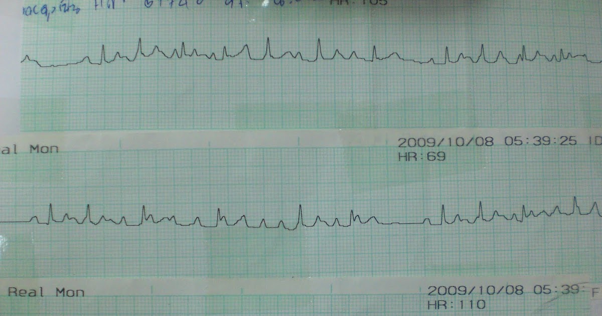 Phimaimedicine: 94. Different 12 lead EKG and monitoring EKG