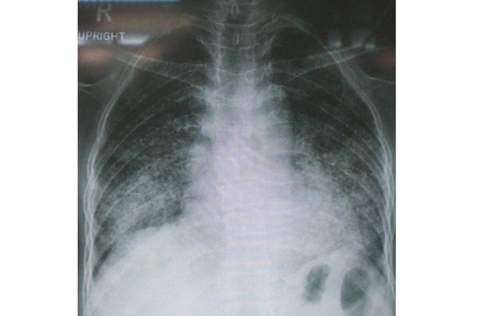 Phimaimedicine: 127. Miliary pattern in chest X-ray