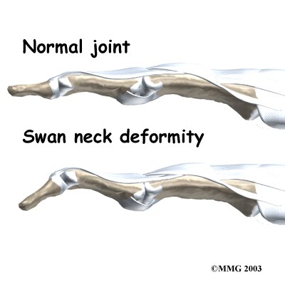 Phimaimedicine: 583. Swan neck deformity