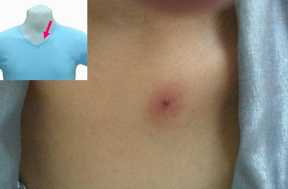 Phimaimedicine: 605. Spider angioma