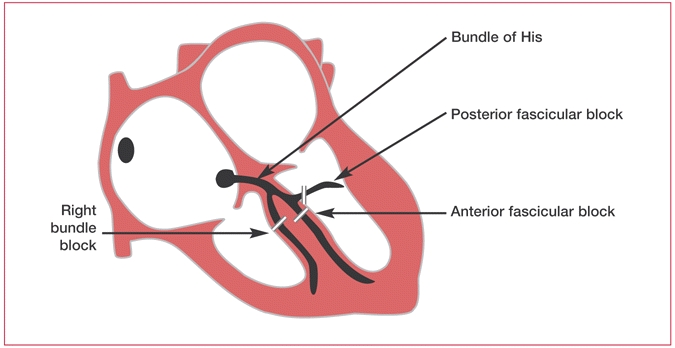 Phimaimedicine: 644. Fascicular block
