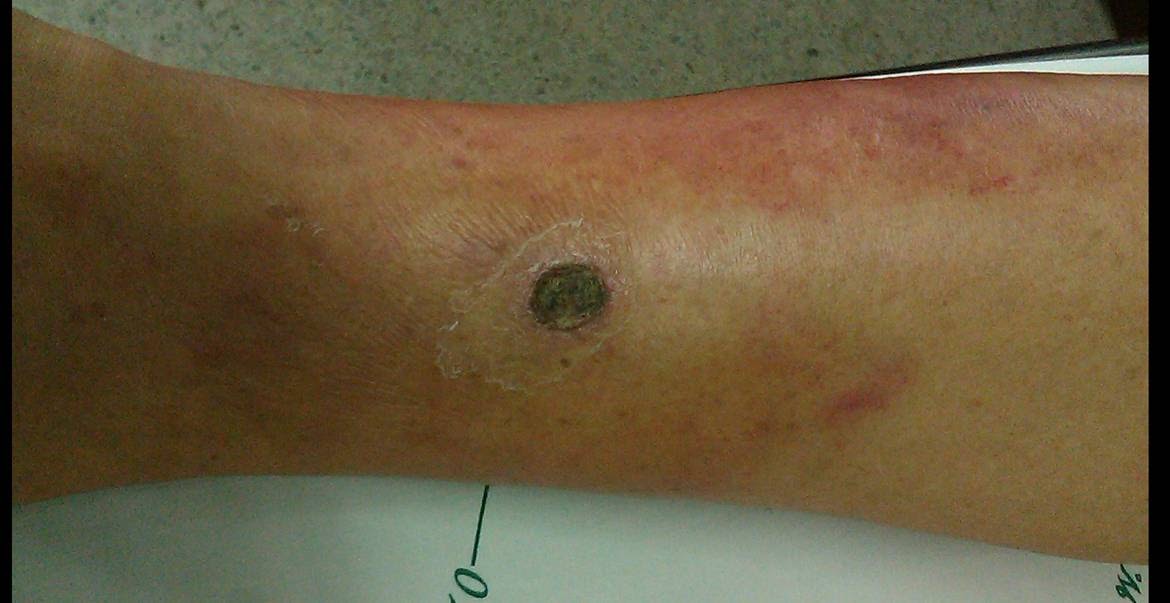 Phimaimedicine: 709. Eschar