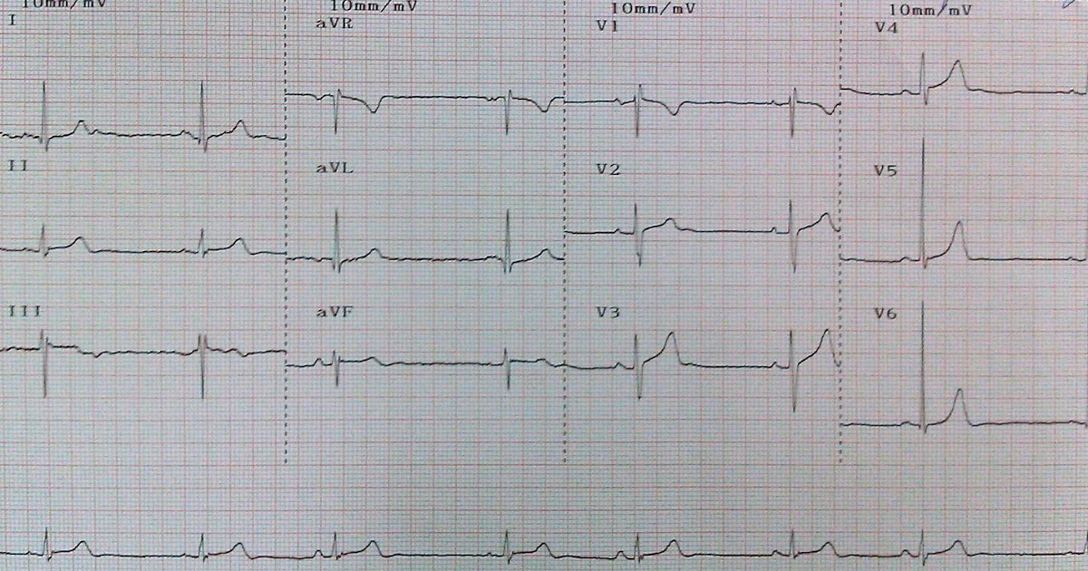 Phimaimedicine: 688. Wandering pacemaker