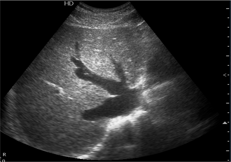 Phimaimedicine: 731. Congestive hepatopathy