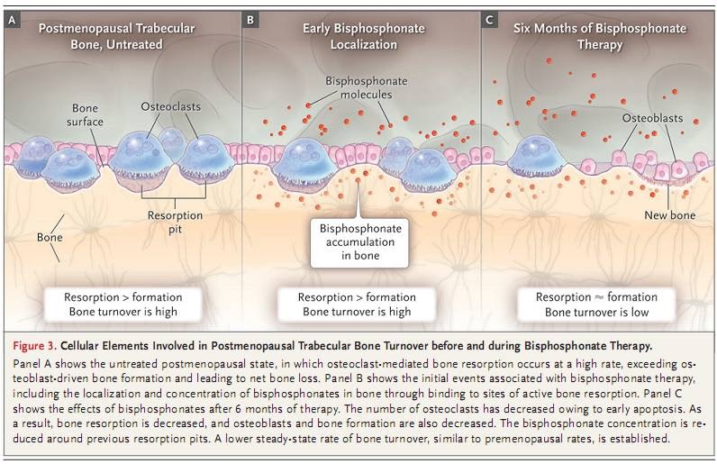 Phimaimedicine: 898. Bisphosphonates for osteoporosis