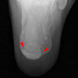 BASIC X-RAY: CALCANEAL FRACTURE