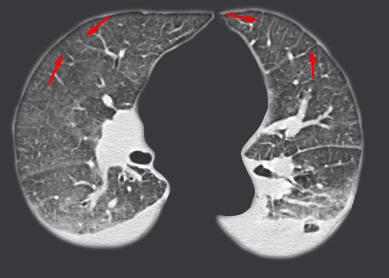 e-CT SCAN: HRCT LUNGS-SEPTAL THICKENING