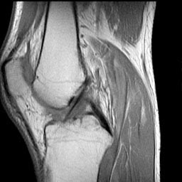 UNDERSTANDING MRI: MR ANATOMY OF KNEE JOINT