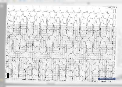 ECG - An Easier Way Of Learning: PACEMAKERS