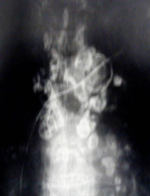 atlas of medicine: egg shell calcification