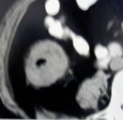 atlas of medicine: donut sign