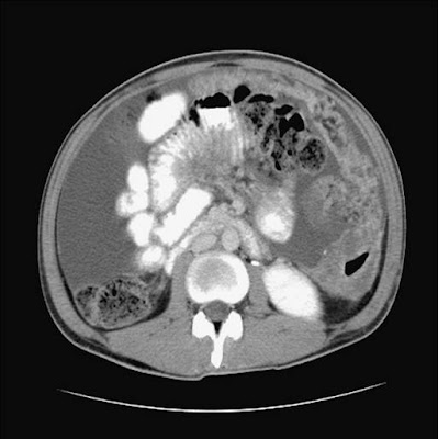 atlas of medicine: omental cake