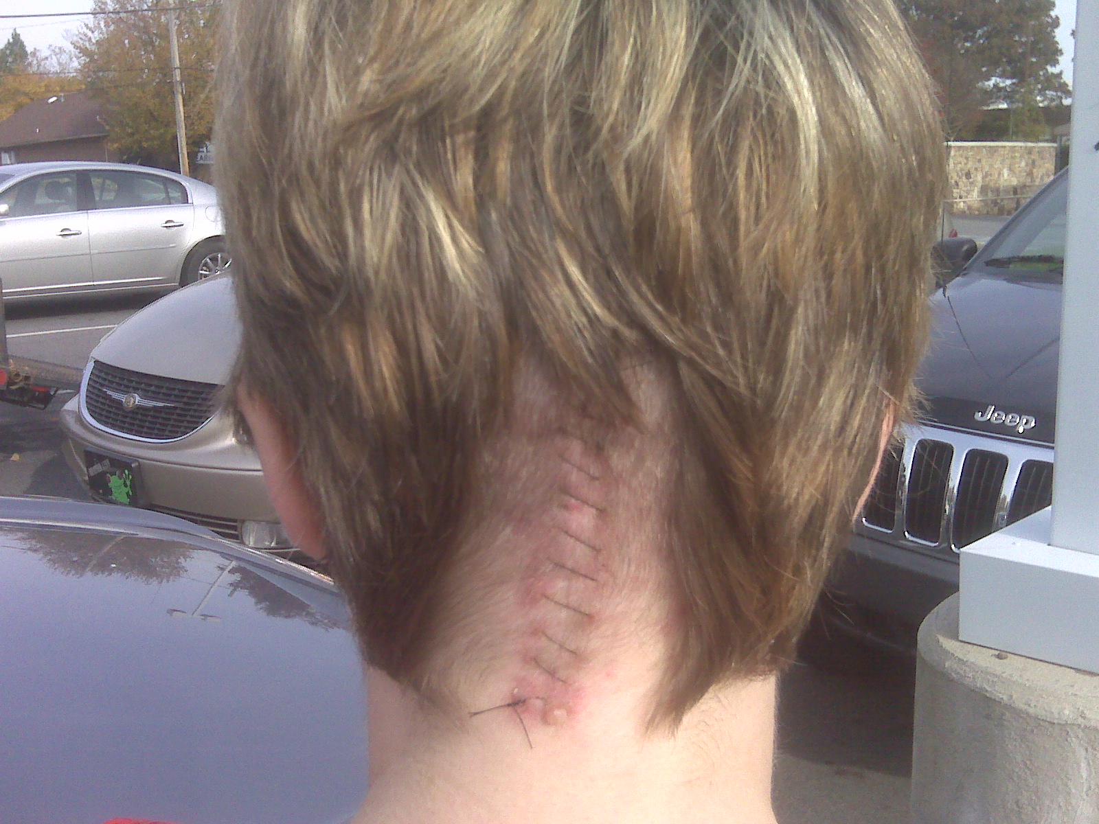 Molly's Brain: Four Weeks Post-Op: Gnarly Scar Pictures!