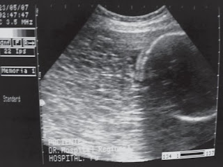 CLINICA DE LA MUJER: Embarazo gemelar con mola hidatidiforme parcial y ...