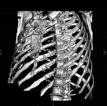 Cuidados Respiratorios: Australia - Estudio piloto de fijación ...