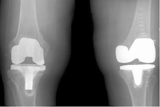 Joint Preservation and Replacement : Knee Replacement in wind swept ...