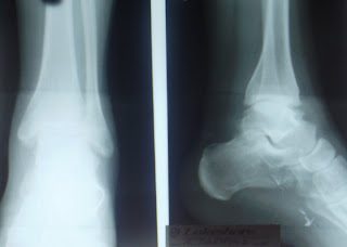 Joint Preservation and Replacement : Arthroscopic ankle fusion