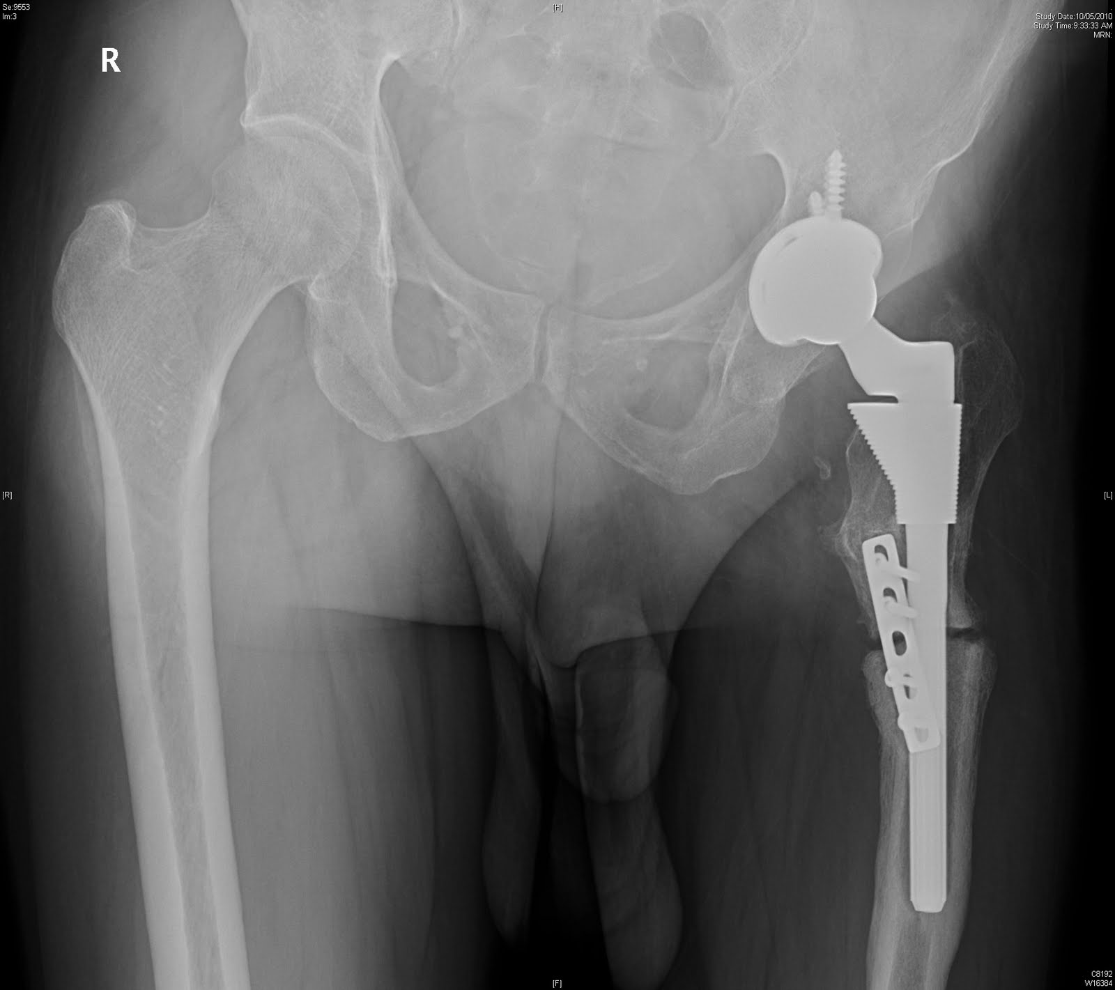 Joint Preservation and Replacement : Sub troch nonunion for THR post ...