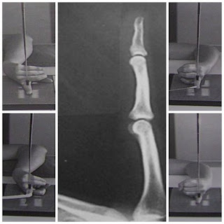 Rayos 2011: Dedos (Segundo a Quinto)