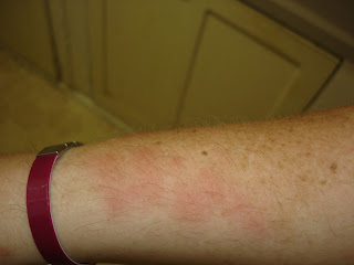 As My Fibro World Turns: Red thick scaly rash photos