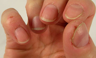 A Case of Cracked Fingers