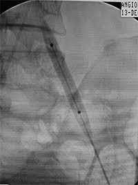 Radiologi Intervensi (Interventional Radiology)