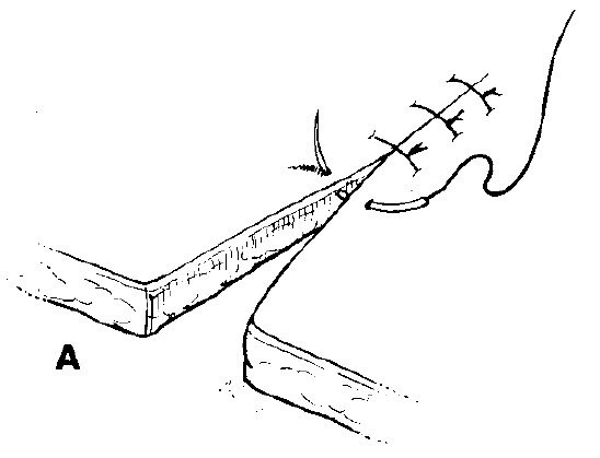 Procedimientos básicos de Enfermería en AP: PATRONES DE SUTURA