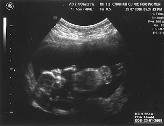 The Bub in the Belly: Scan at 14 weeks